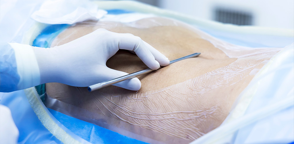 TLIF (Transforaminal Lumbar Interbody Fusion) - University Spine Center